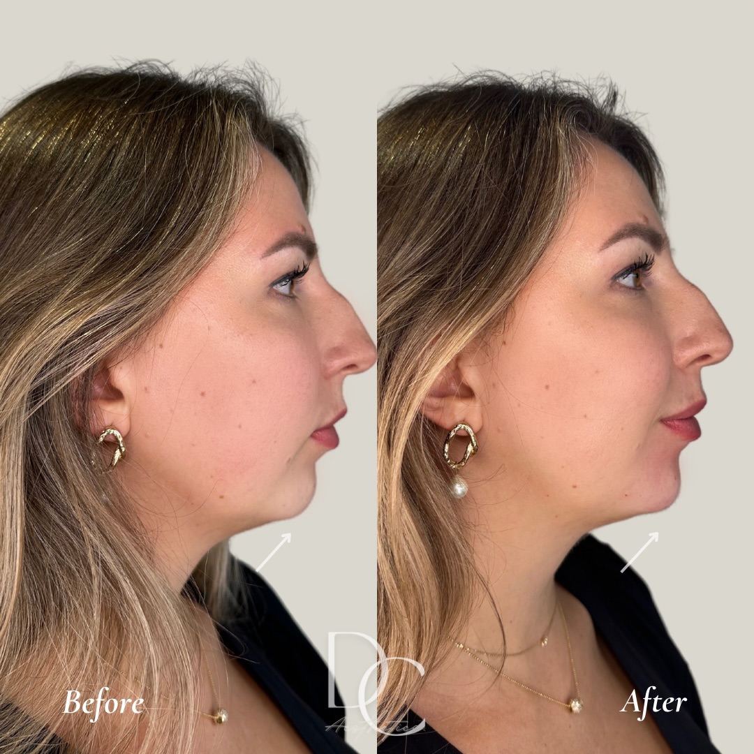 Why Chin Filler is getting so popular? | DC Aesthetics