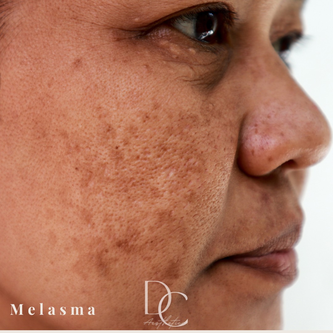 How do hormones affect our skin – dryness, sensitivities, wrinkles ...