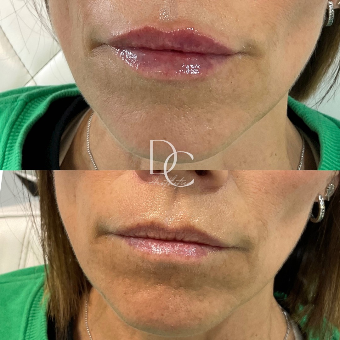 Lip Flip or Lip Filler? - DC Aesthetics Injectables & Skin Gold Coast