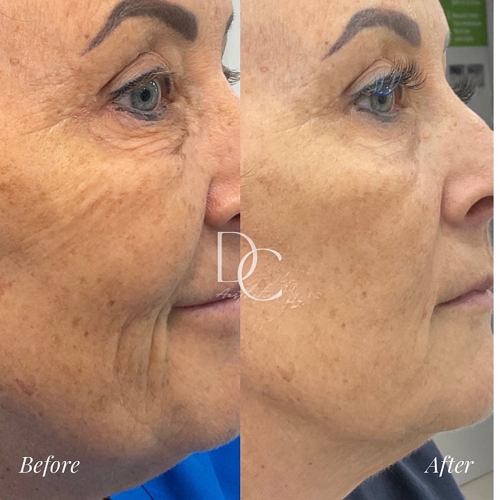 Bio Remodelling Gold Coast | DC Aesthetics