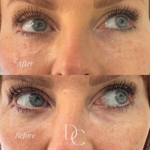 Skin Booster Injectables Gold Coast | DC Aesthetics